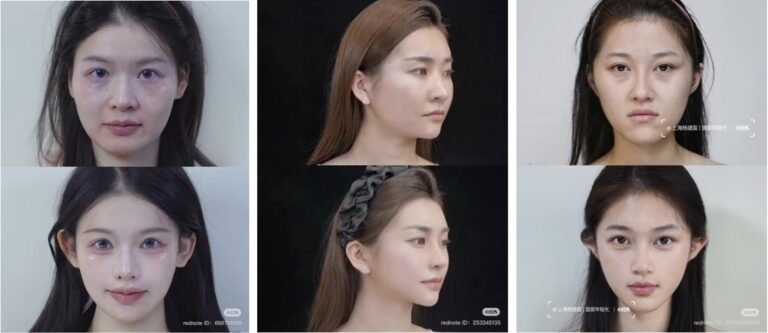 Plastic surgery in China: From beauty ideals to black market